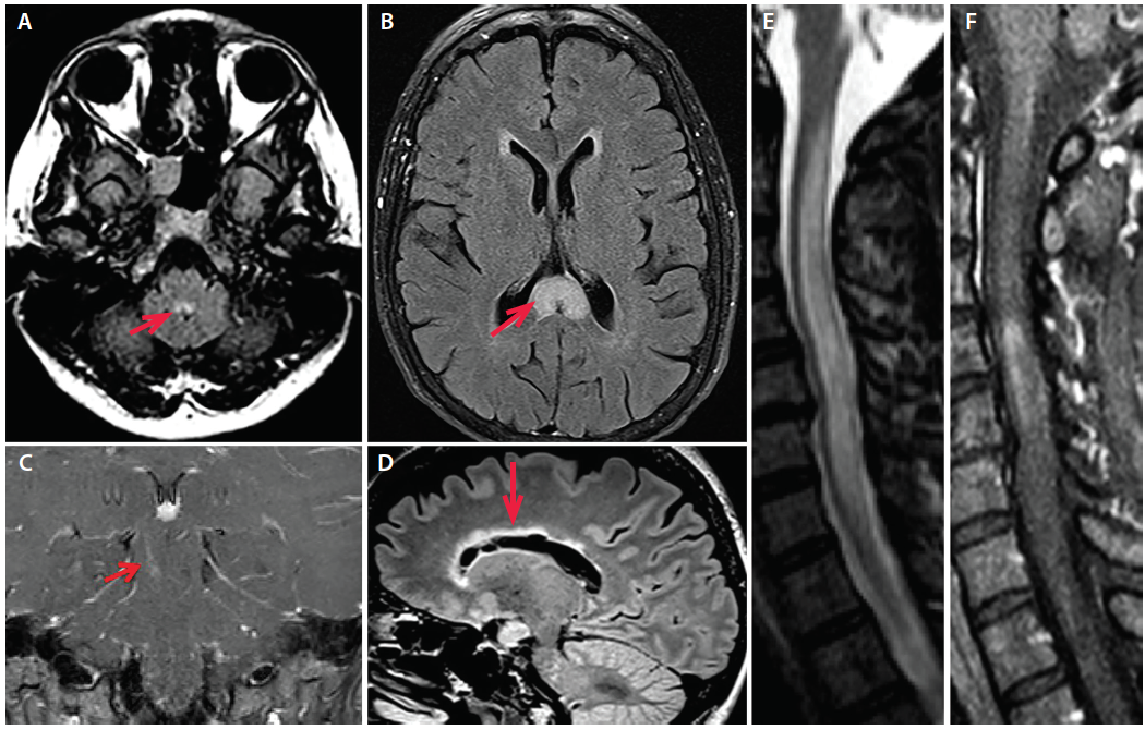 Neuromyelitis Optica Spectrum Disorders