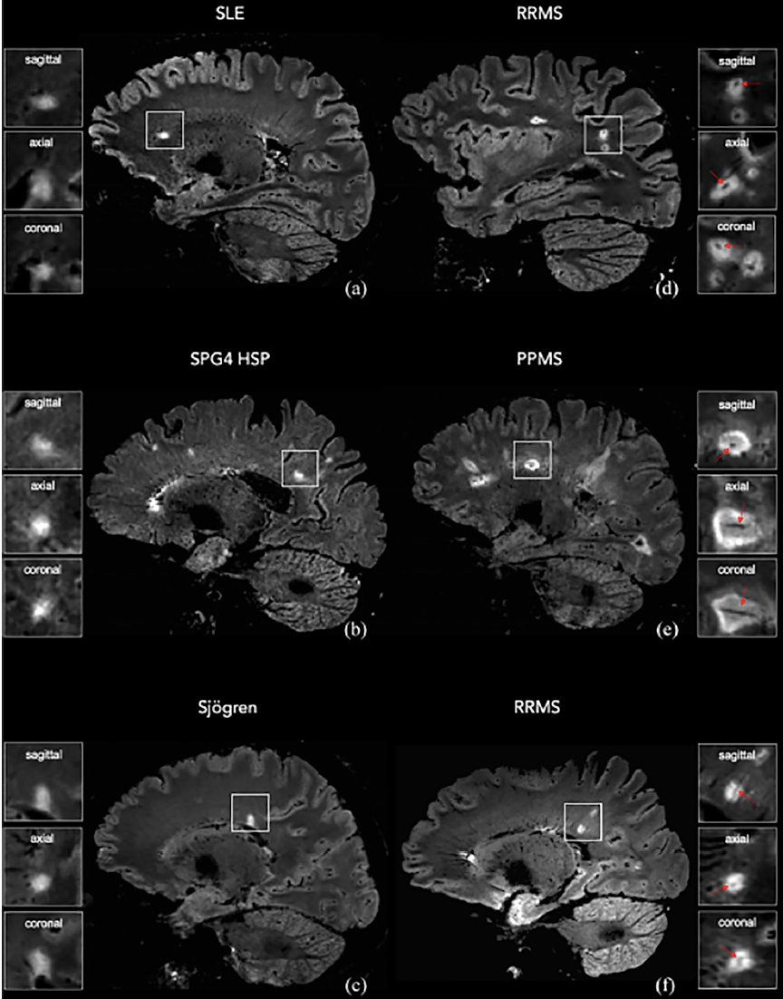 The Central Vein Sign