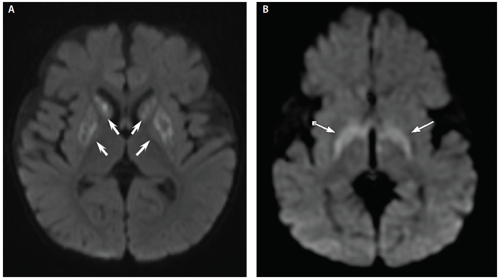Stroke Snapshot: Metabolic Stroke