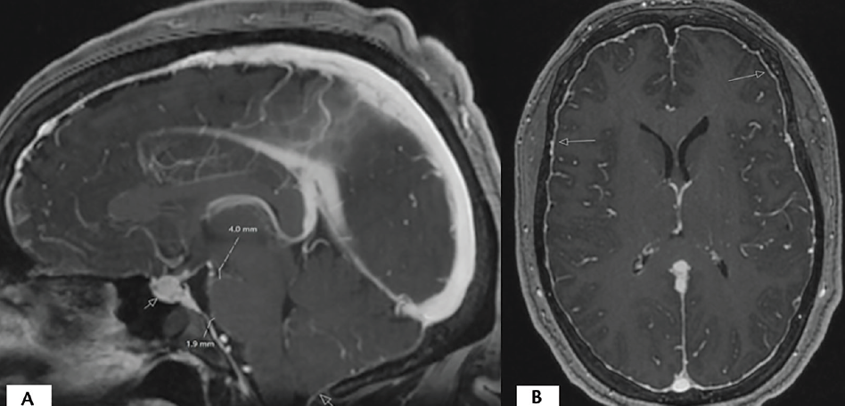Headache Attributed to Spontaneous Intracranial Hypotension