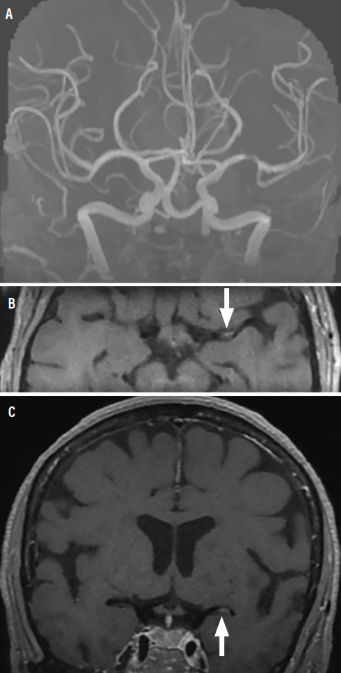 Stroke Snapshot: Intracranial MRI Vessel-Wall Imaging
