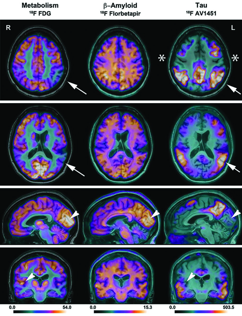 neuroimaging biomarkers in alzheimer disease & dementia