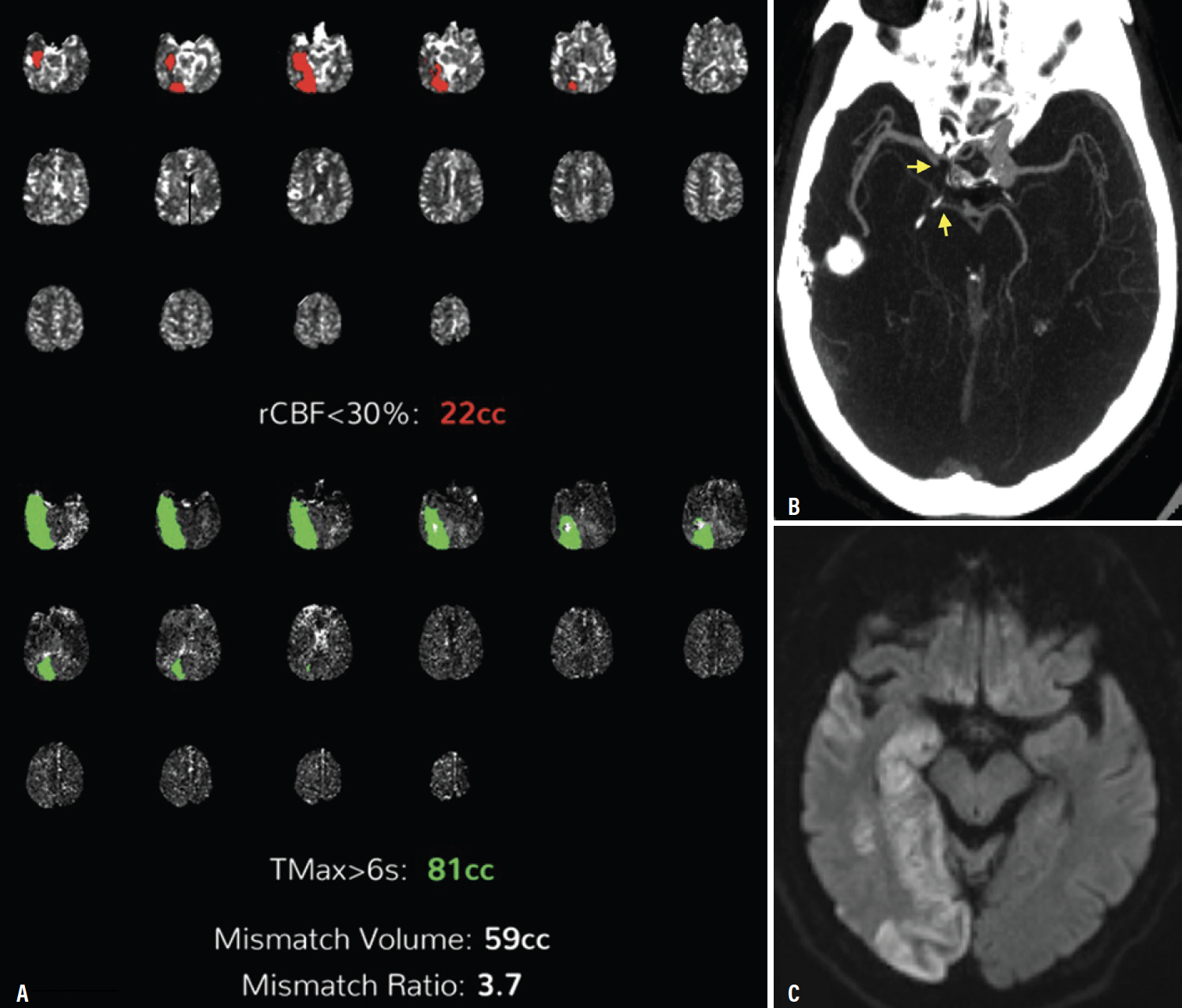 Ischemic Stroke Imaging