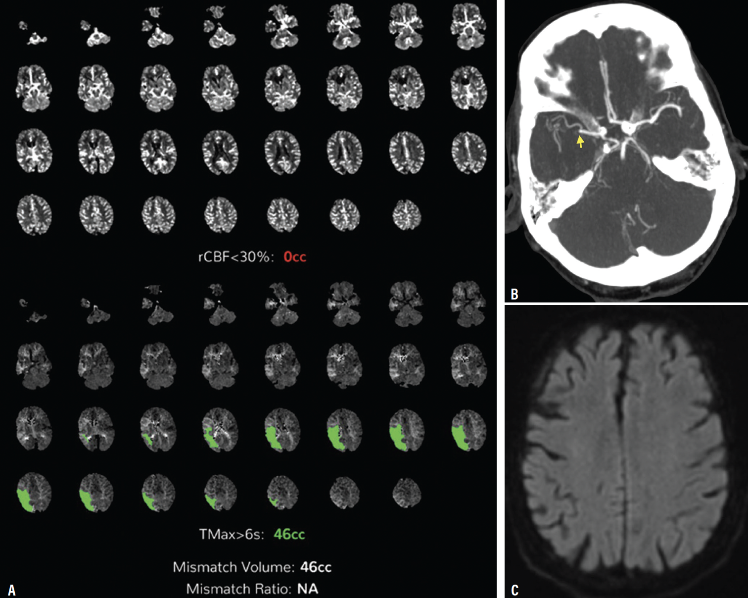 Ischemic Stroke Imaging