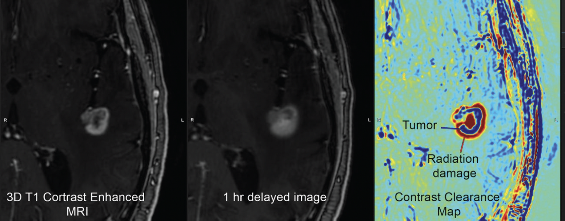 Neuroimaging After Brain Radiotherapy and Radiosurgery