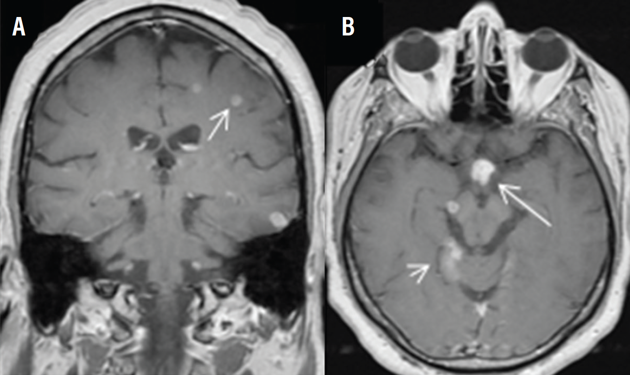 Intracranial Infections: Bacterial, Viral, Fungal, Parasitic