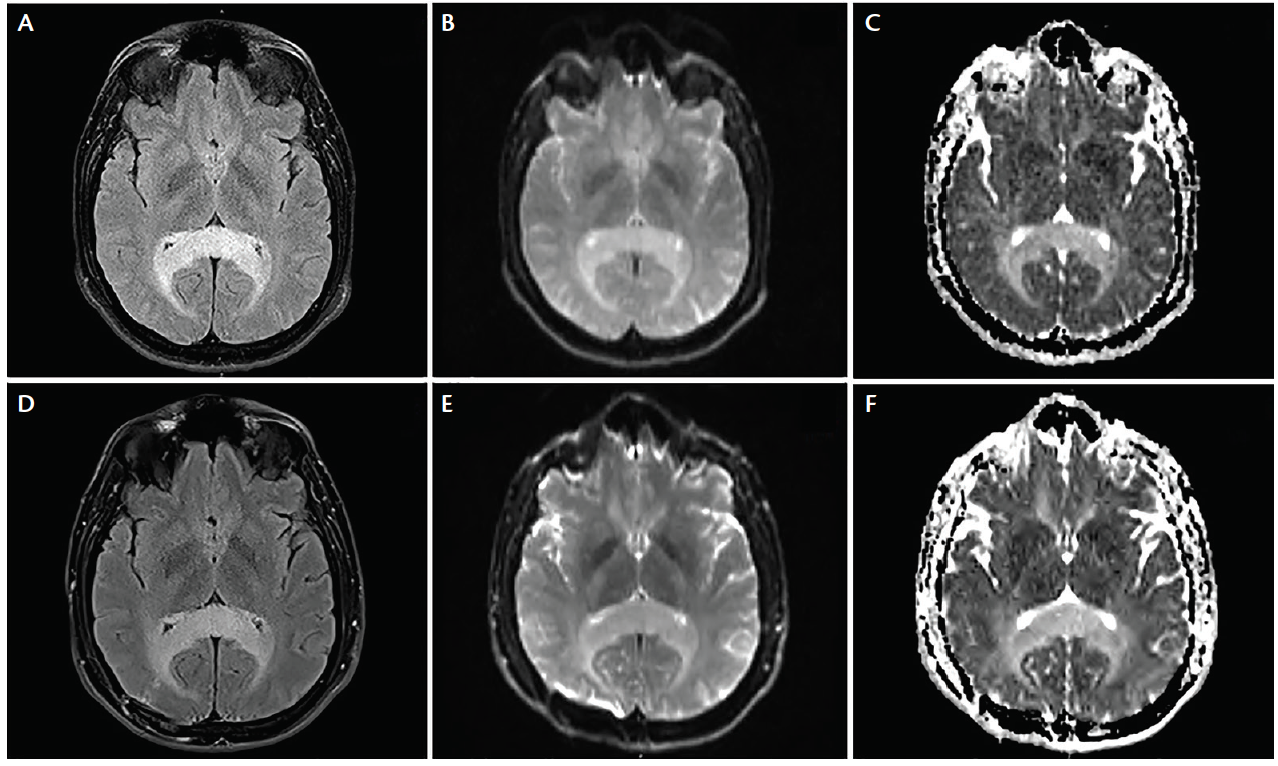 Reversible and Benign Lesions of Splenium of The Corpus Coll