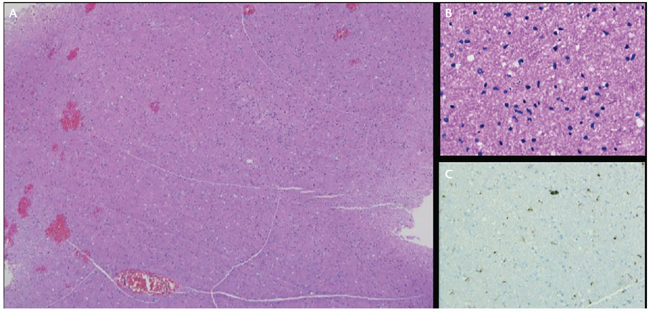 Reversible and Benign Lesions of Splenium of The Corpus Coll