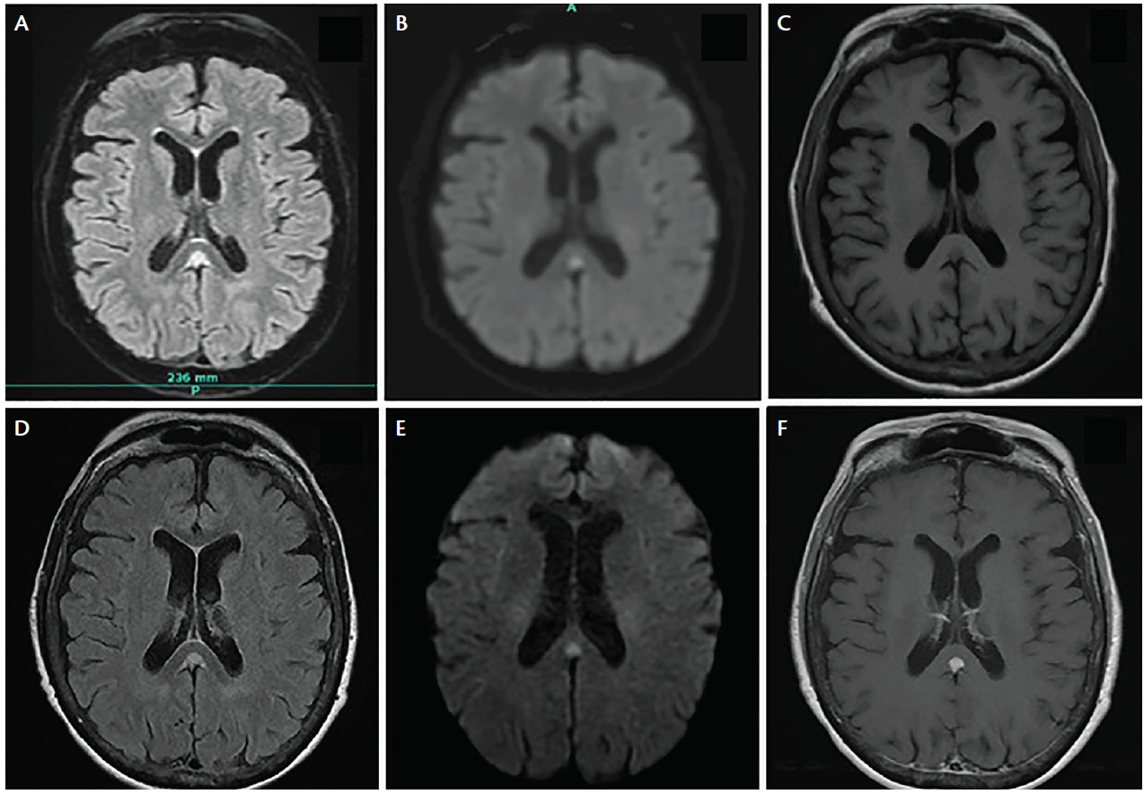 Reversible and Benign Lesions of Splenium of The Corpus Coll