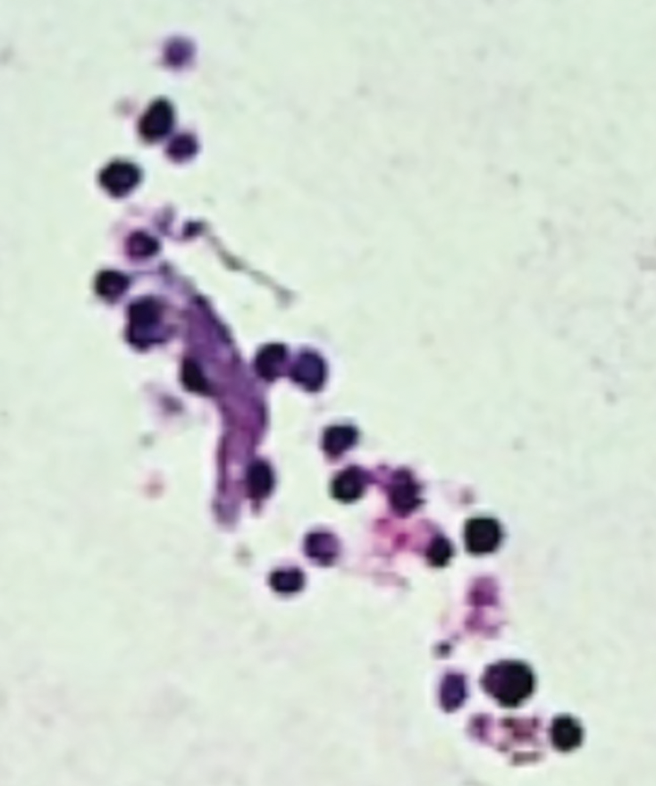 Rapidly Progressive Dementia Caused by Neoplastic Meningitis