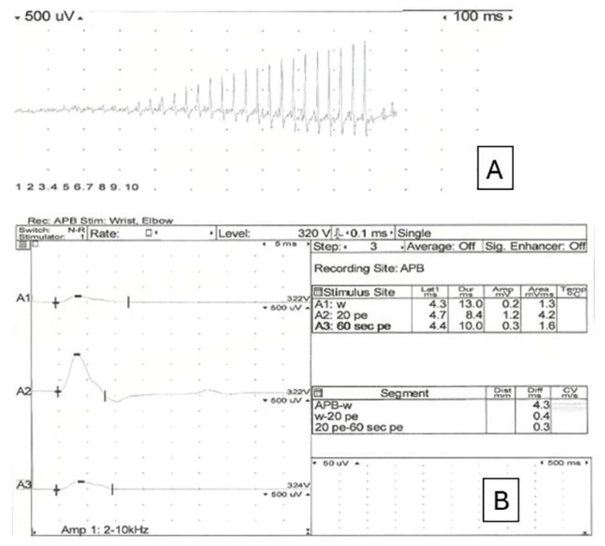 Diagnosis and Treatment of Lambert-Eaton Myasthenic Syndrome