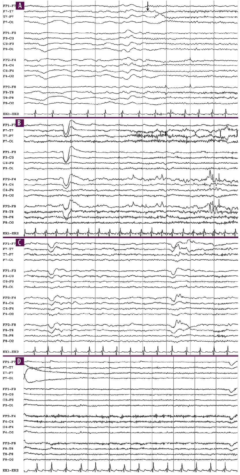 Epilepsy Essentials: VideoEEG Analysis