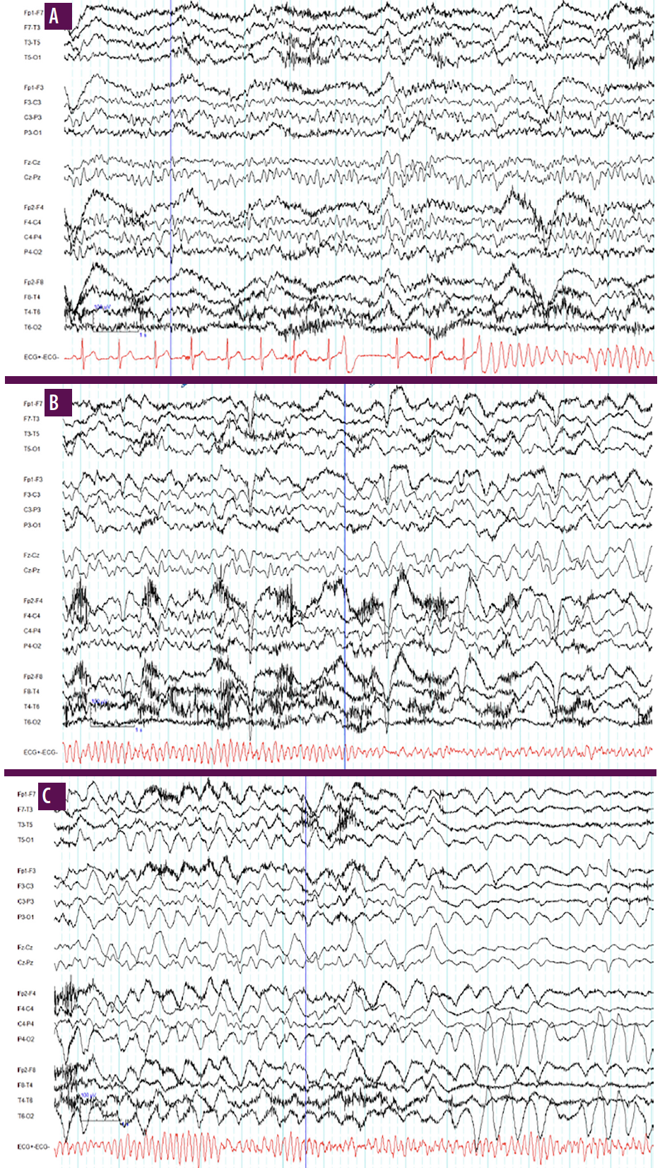 Epilepsy Essentials: VideoEEG Analysis