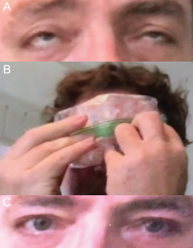 Teleneuro-ophthalmology