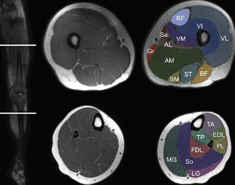 Muscle MRI for Neuromuscular Disorders