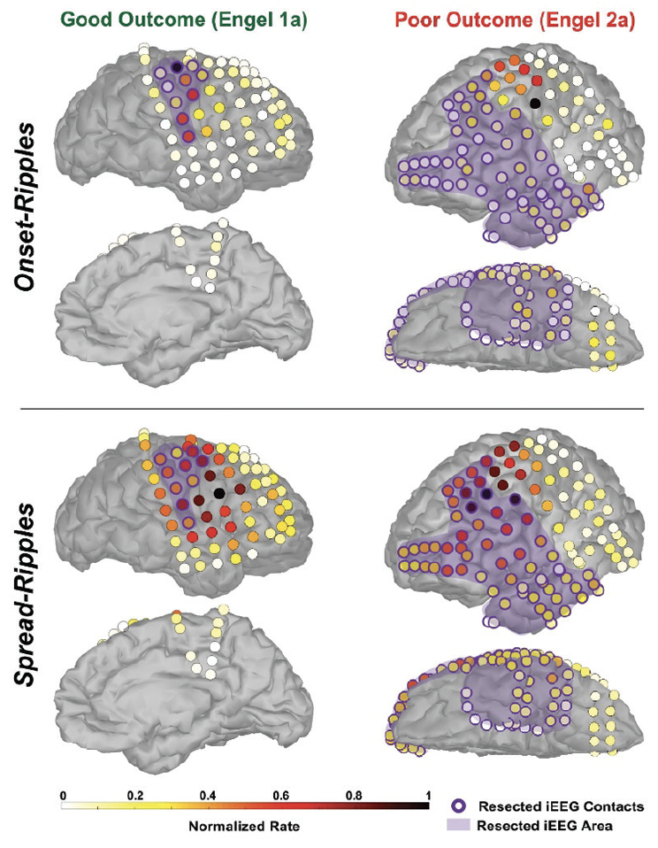 Epilepsy Essentials: Novel Interictal Biomarkers for Delinea