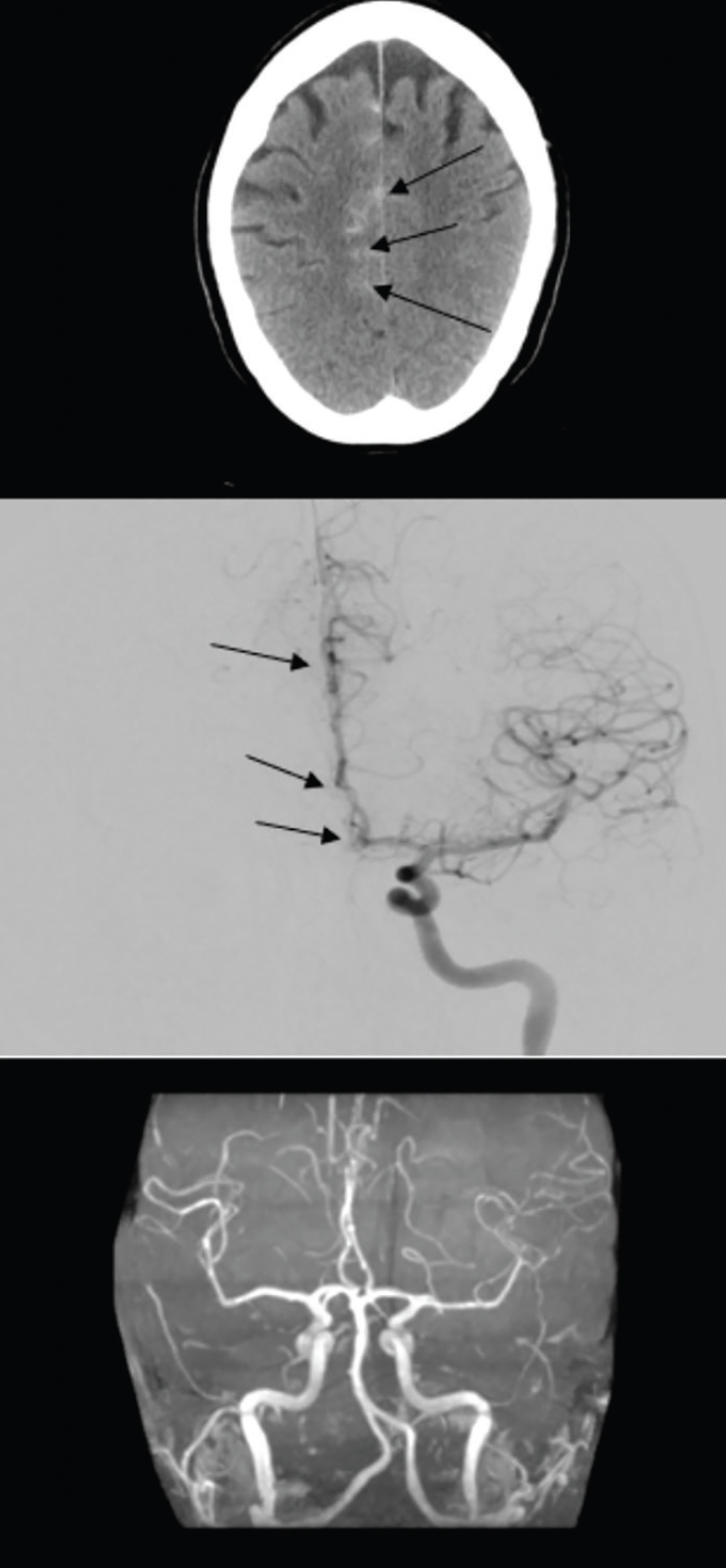 Headache Horizons: Reversible Cerebral Vasoconstriction Synd