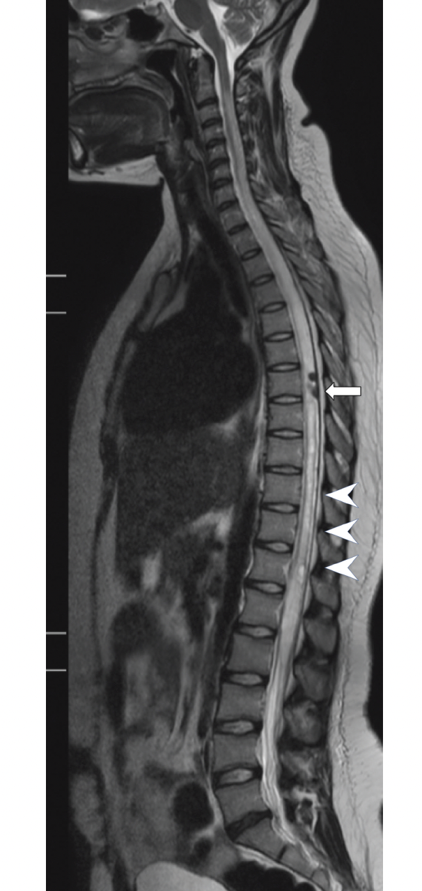 Tuberculous Radiculomyelitis
