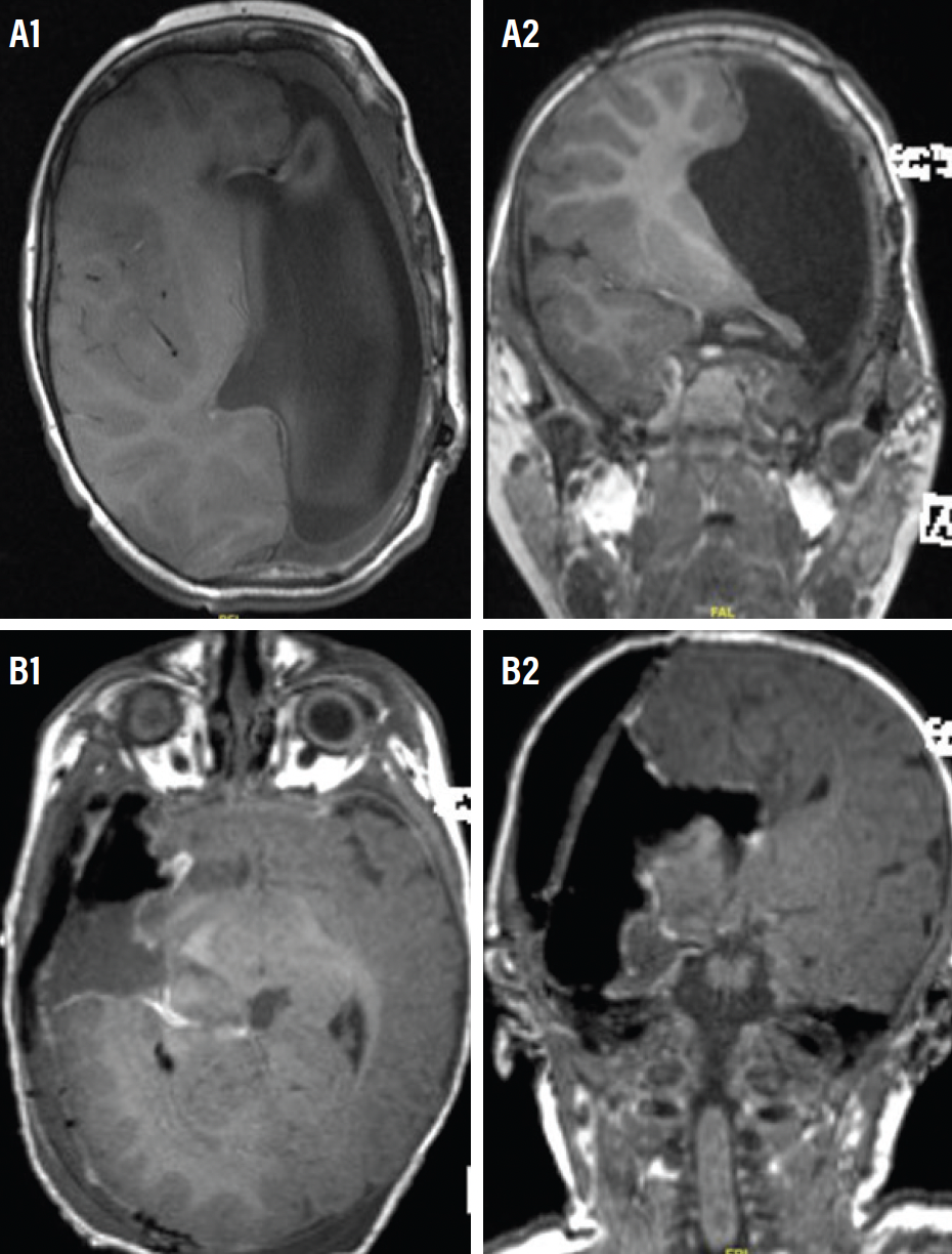 Epilepsy Essentials: Hemispherectomy for Early-Onset Pediatr