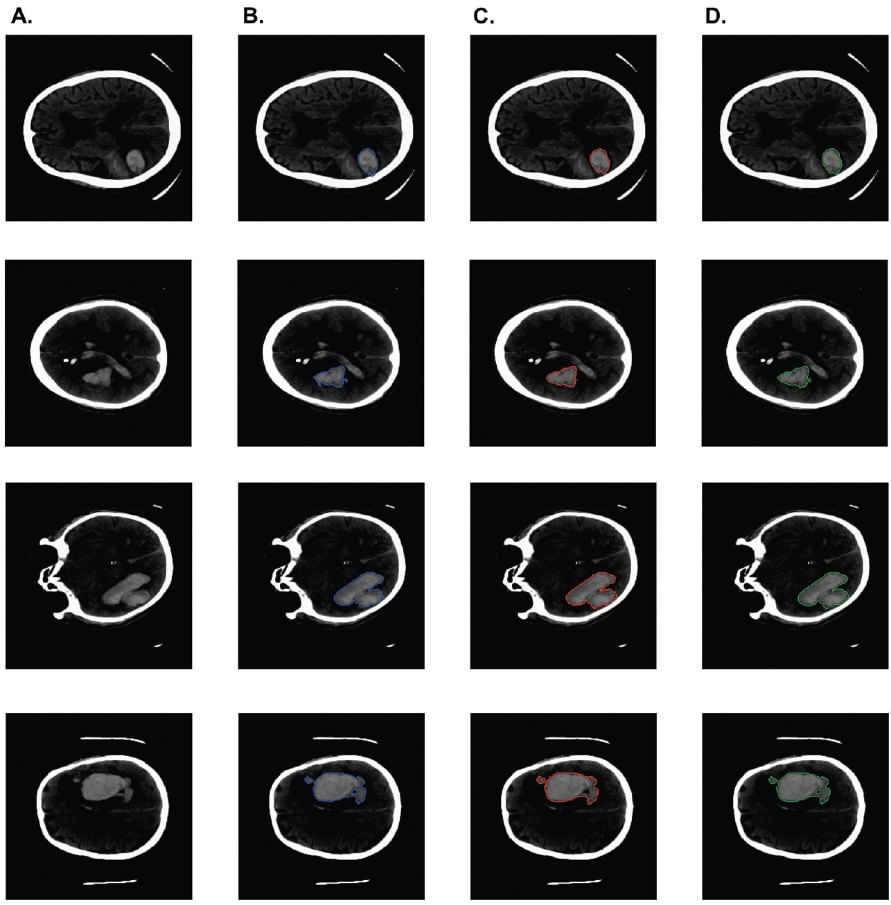 Stroke Snapshot: Incorporating Artificial Intelligence in St