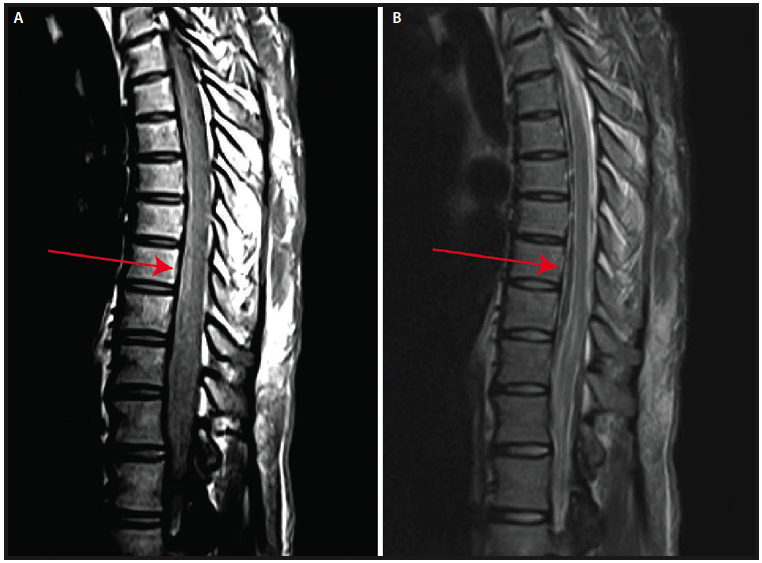 Vasculitis Presenting as a Hypertensive Crisis With Back Pai