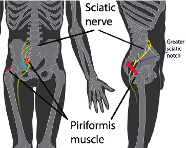 From Piriformis Syndrome to Deep Gluteal Syndrome