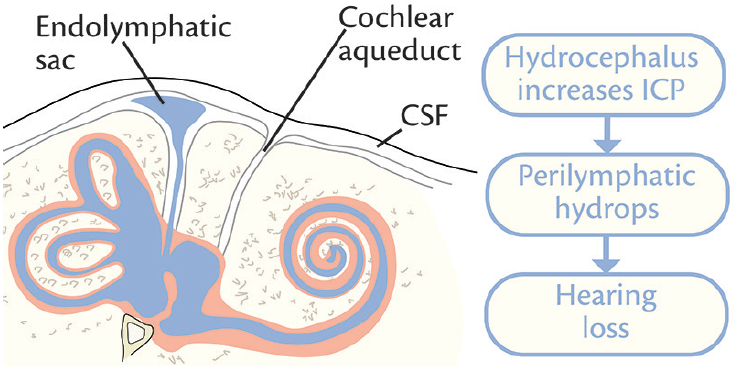 Hearing Loss Associated With Hydrocephalus
