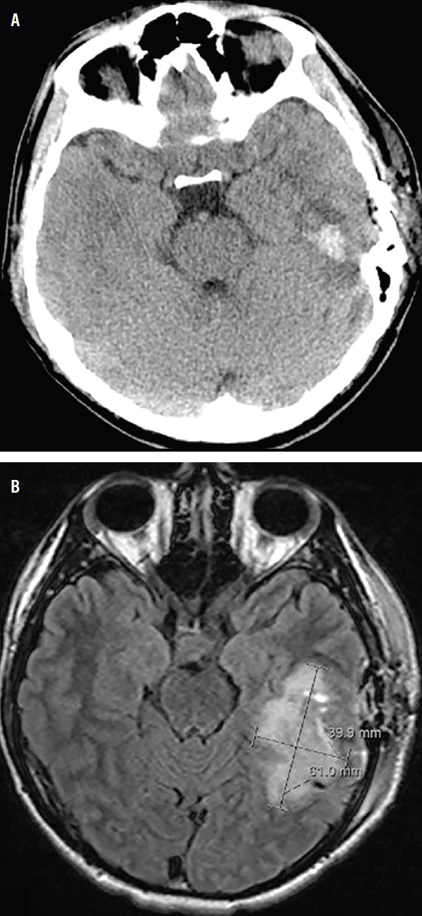 Challenge Case Report: PostCOVID-19 Encephalitis
