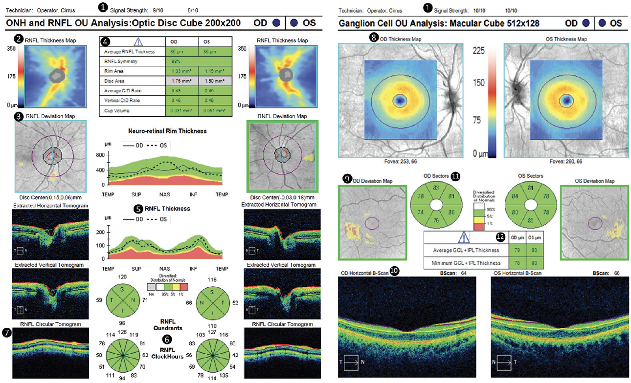 MS Minute: Retinal Optical Coherence Tomography for MS