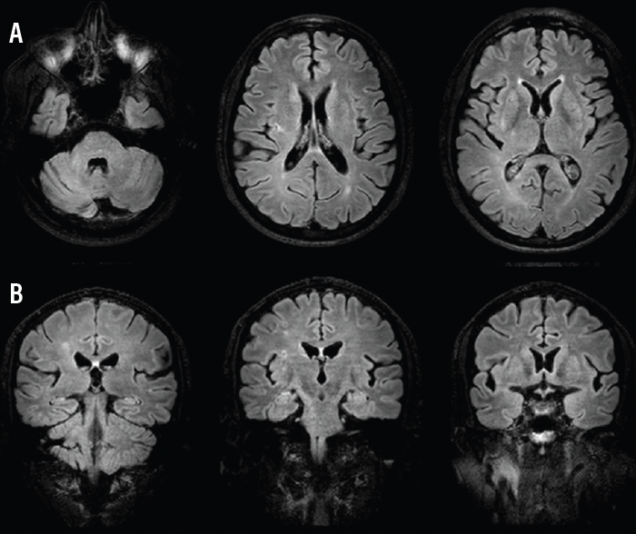 Acute Encephalopathy With Unusual Brain Lesions