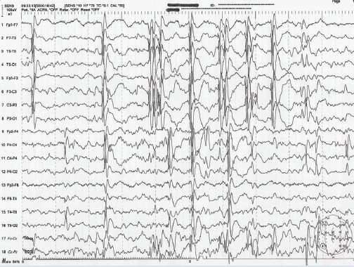 Self-Limited Focal Epilepsies in Childhood