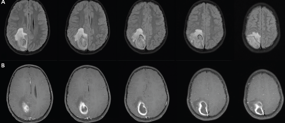 Focal Status Epilepticus 9 Years After Brain Abscess