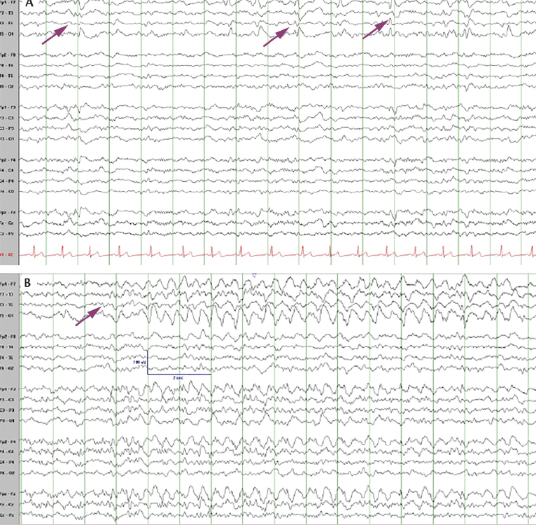 Autoimmune-Associated Epilepsy