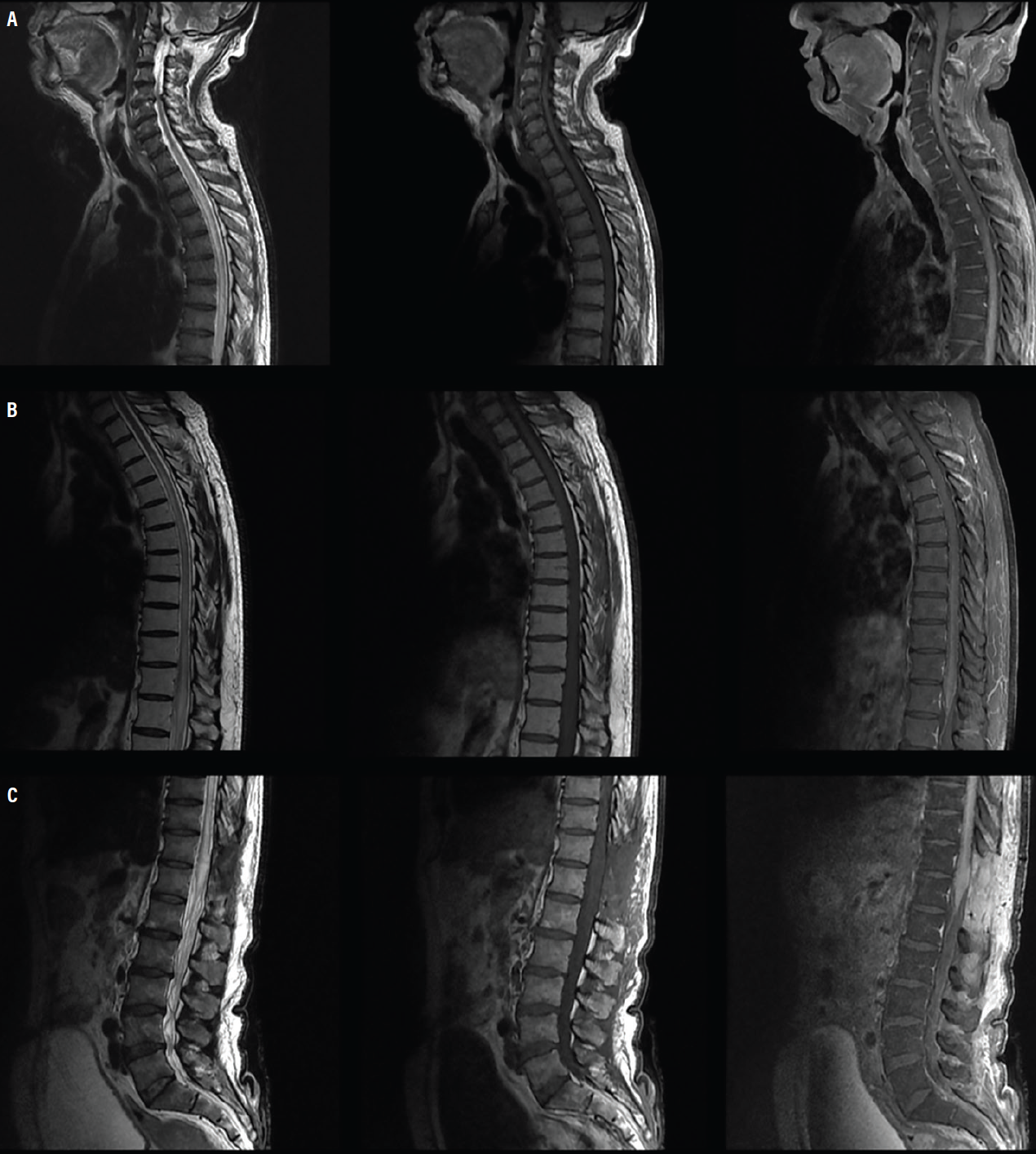 Case Report: Occult Spinal Dural Arteriovenous Malformation