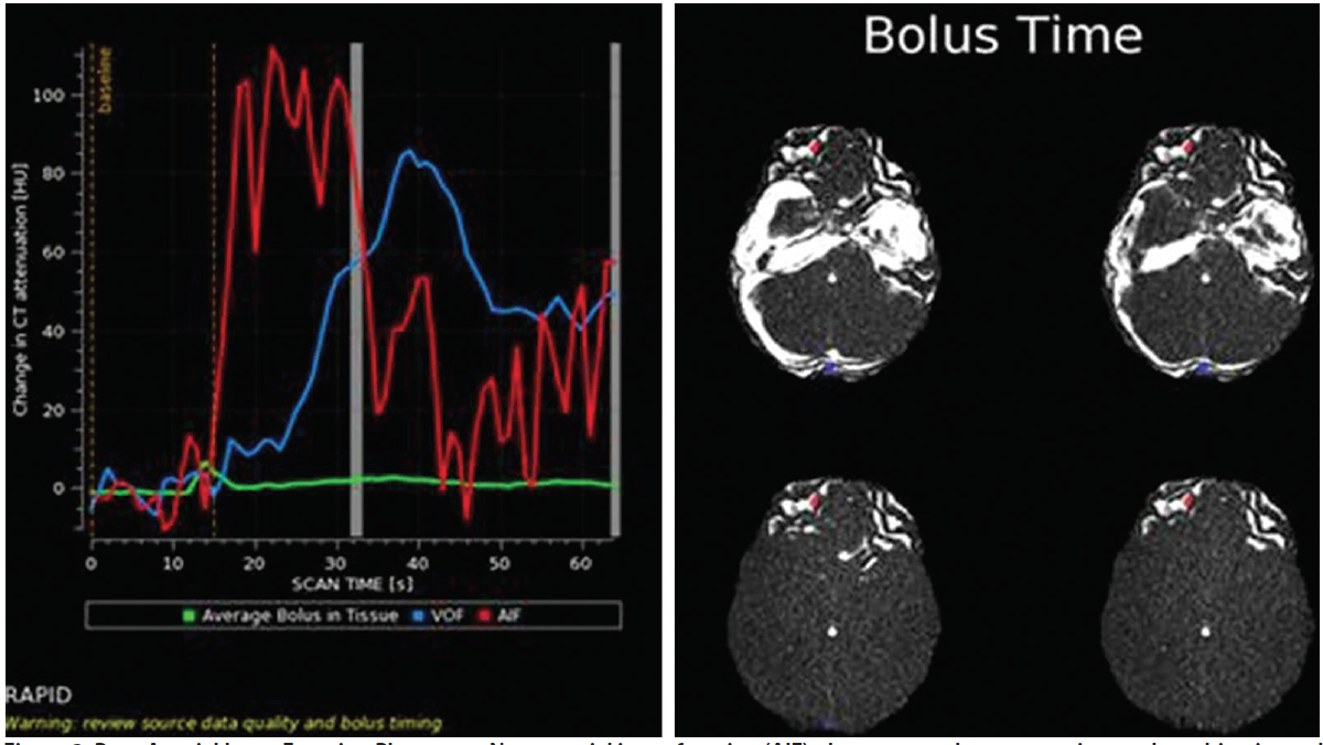 RAPID Automated CT Perfusion in Clinical Practice