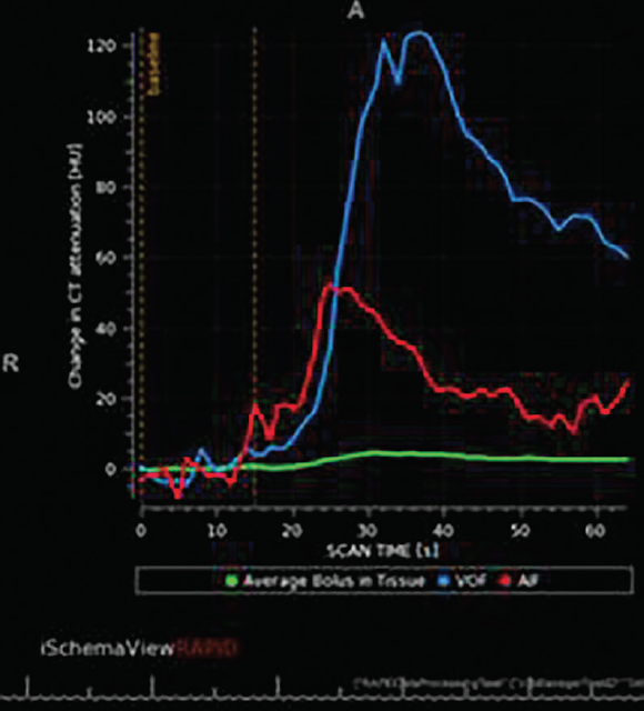 RAPID Automated CT Perfusion in Clinical Practice
