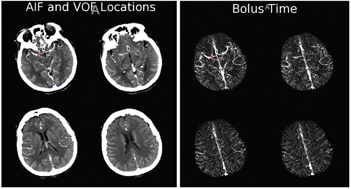 RAPID Automated CT Perfusion in Clinical Practice