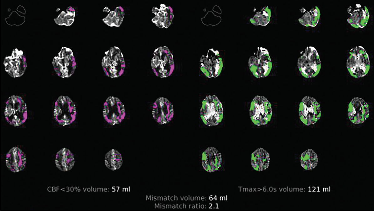 RAPID Automated CT Perfusion in Clinical Practice
