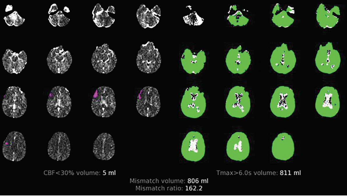 RAPID Automated CT Perfusion in Clinical Practice