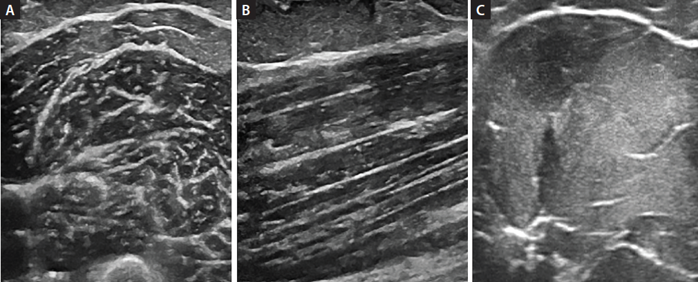 Ultrasound in Neuromuscular Medicine
