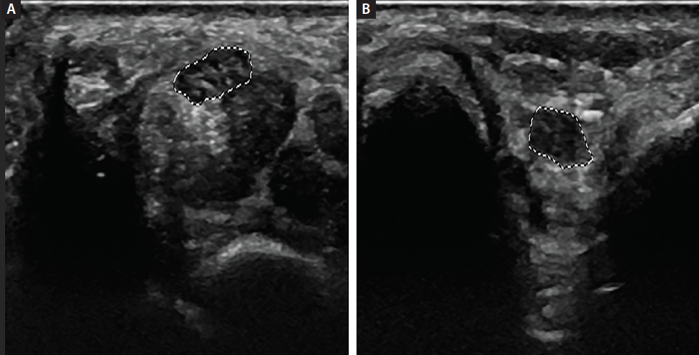 Ultrasound in Neuromuscular Medicine