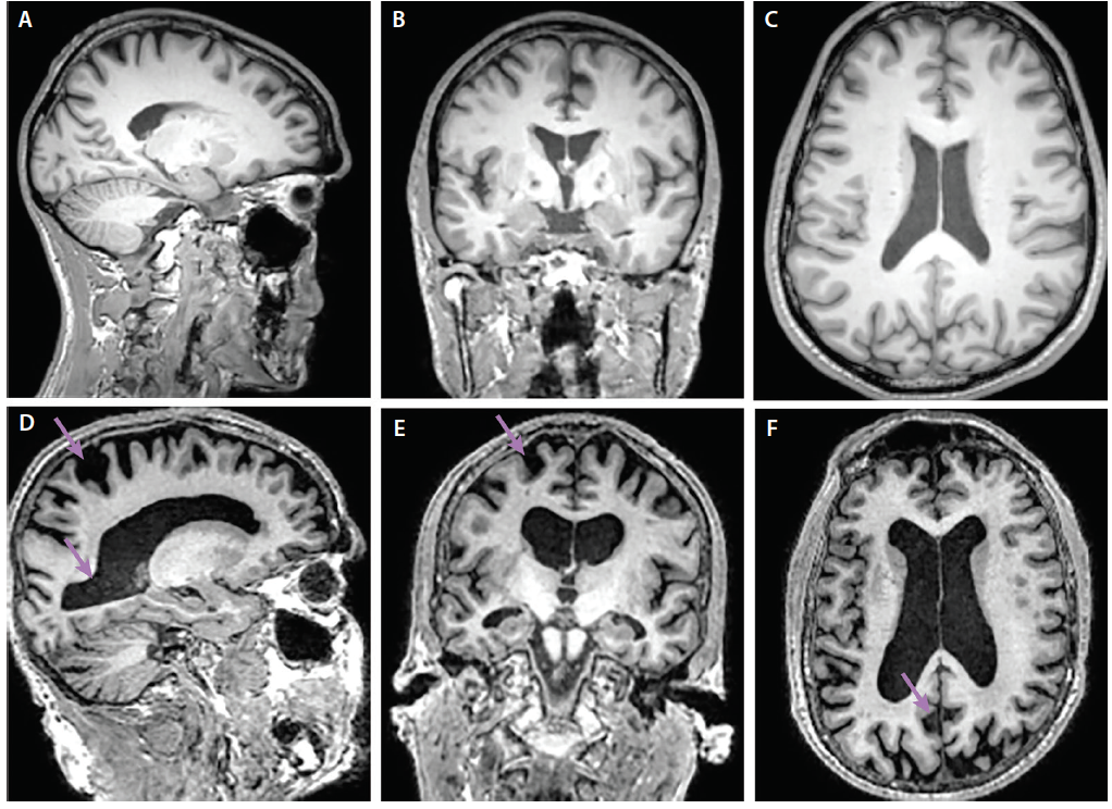 Neuroimaging and Alzheimer’s Disease