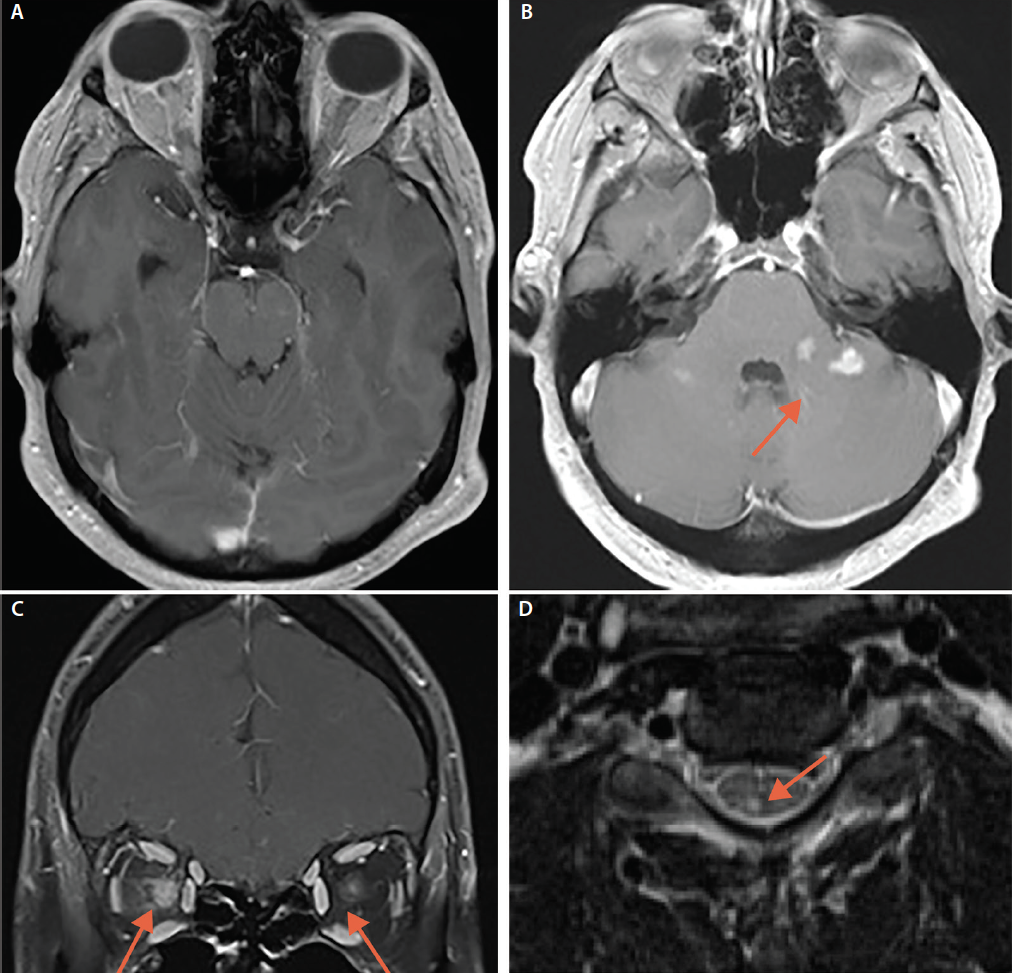 Case Report: Seizure, Fever, Hallucinations, & Vision Loss