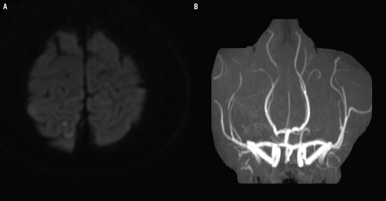 Case Report: Reversible Cerebral Vasoconstriction Syndrome P