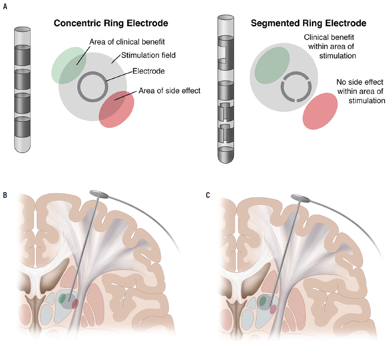 Movement Disorders Moment Deep Brain Stimulation In Movemen