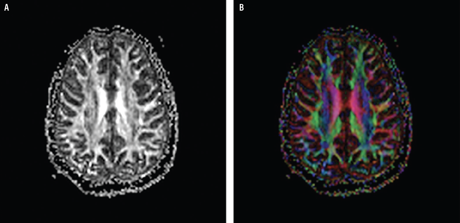 TBI Today: Quantitative Diffusion Tensor Imaging for Assessm