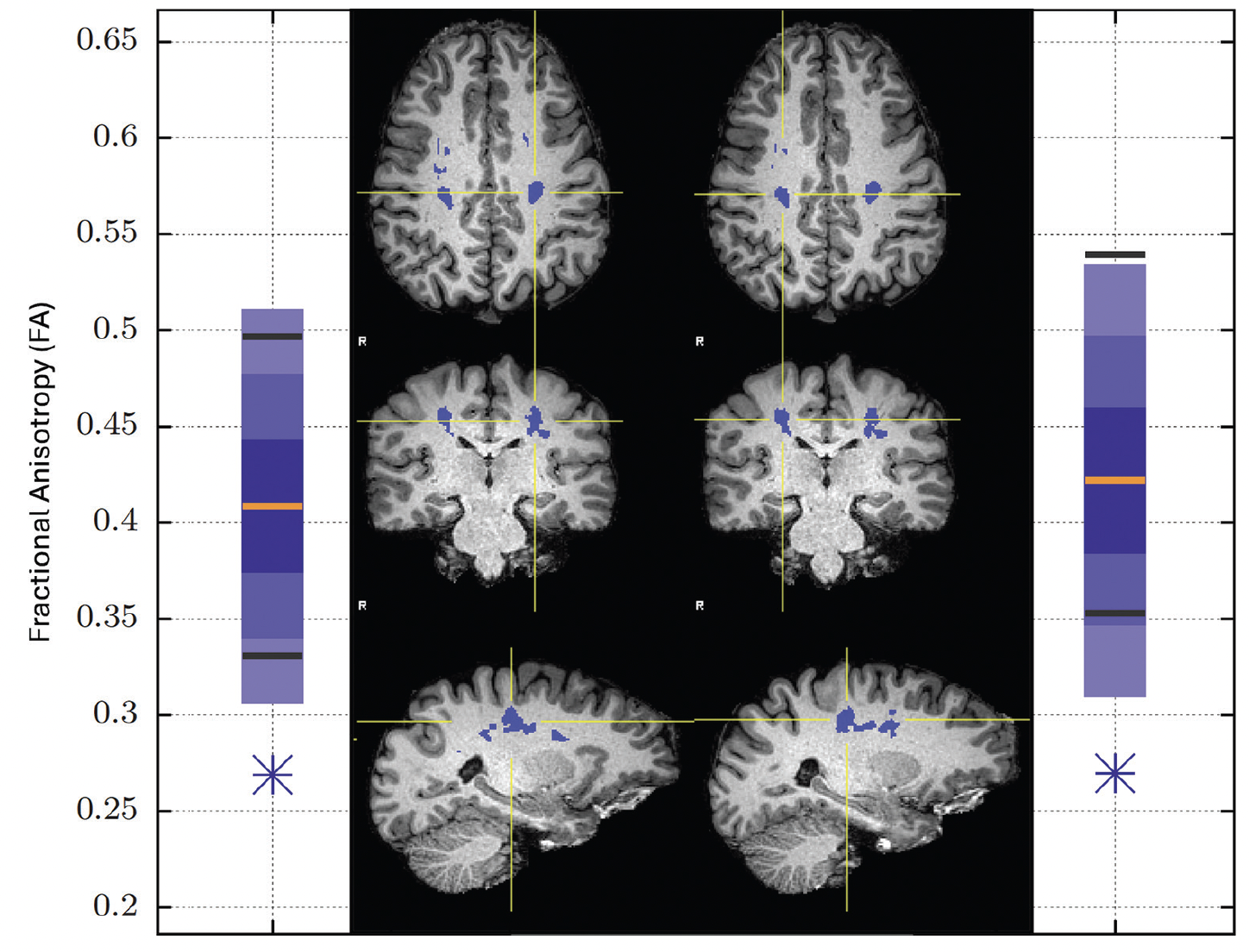 TBI Today: Quantitative Diffusion Tensor Imaging for Assessm