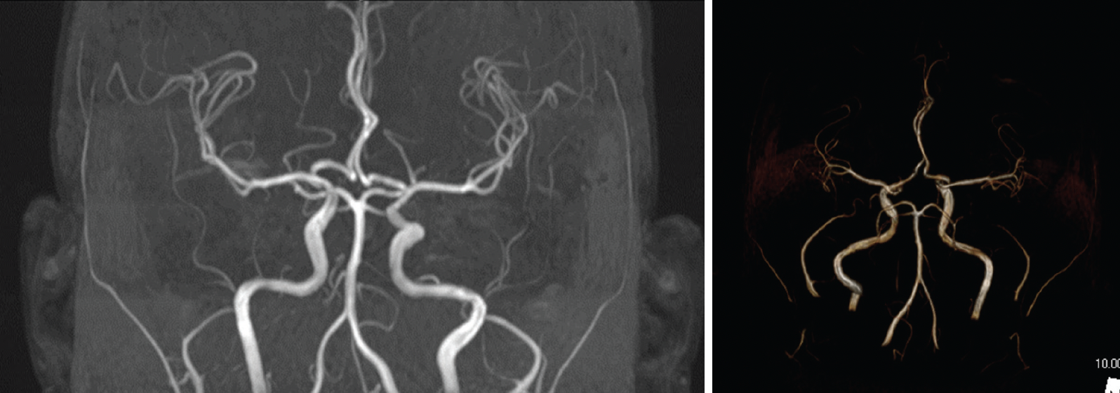 Stroke in a Young Adult:Immunomodulation-Responsive Bilatera