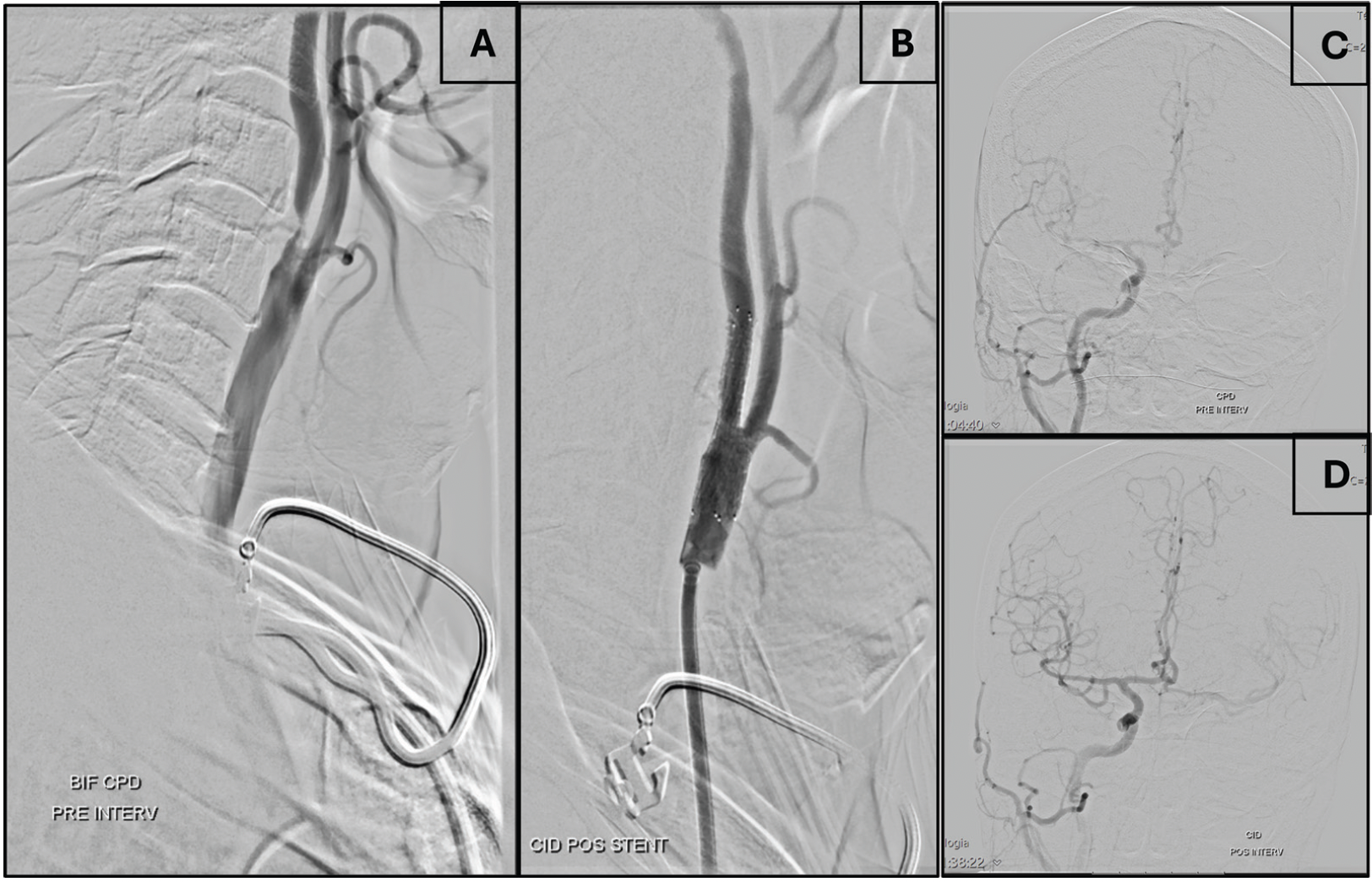 Critical Bilateral Carotid Artery Disease Presenting as Hemi