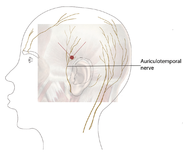 Procedural Treatments for Headache Disorders